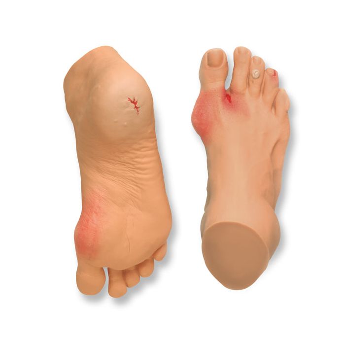 Common Foot Abnormalities - SAVELIVES